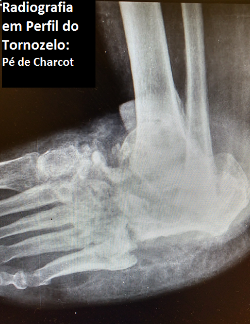 Pe De Charcot Agudo CHARCOT FOOT