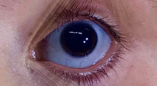 Esclera azul: quais doenças clínicas podemos pensar diante dessa ...