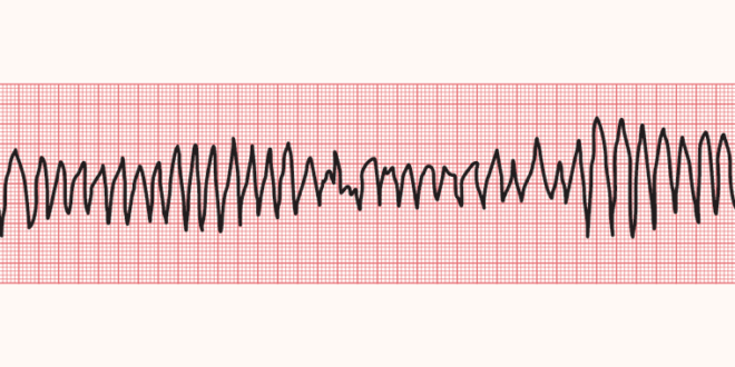 Torsades de pointes: guia de ECG - PEBMED