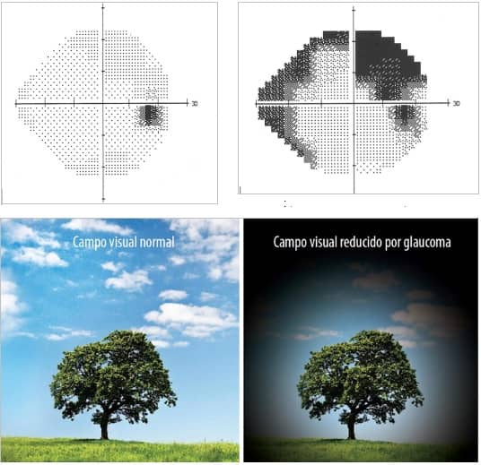 Glaucoma: um inimigo silencioso - PEBMED