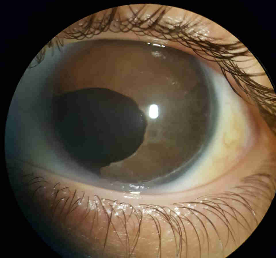 O que é síndrome de Axenfeld-Rieger e quais os critérios diagnósticos ...