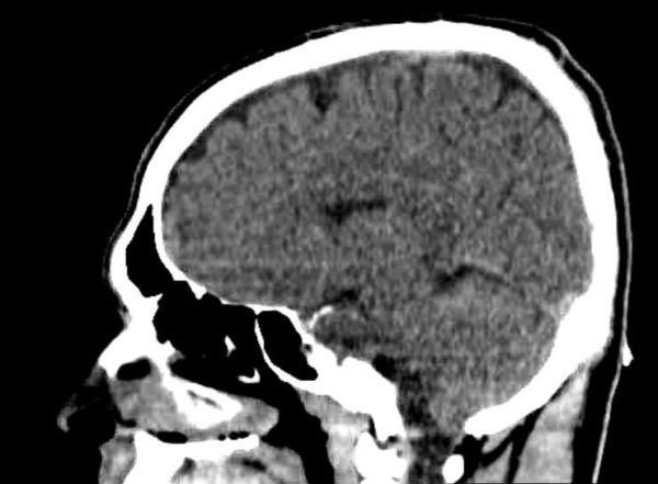 Veja o que você precisa saber sobre cordomas de base de crânio - PEBMED