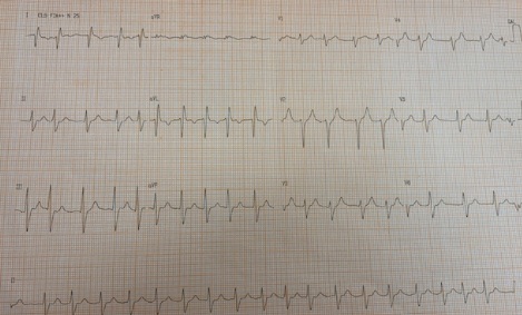 Síndrome de ALCAPA, você conhece? - PEBMED
