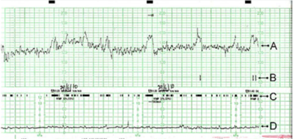 REVISTA SUSTINERE: Cardiotocografia: para que serve, quando solicitar e ...