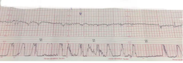 REVISTA SUSTINERE: Cardiotocografia: para que serve, quando solicitar e ...