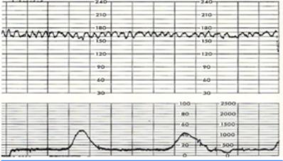 REVISTA SUSTINERE: Cardiotocografia: para que serve, quando solicitar e ...